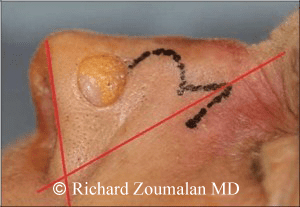 bilobed flap marking